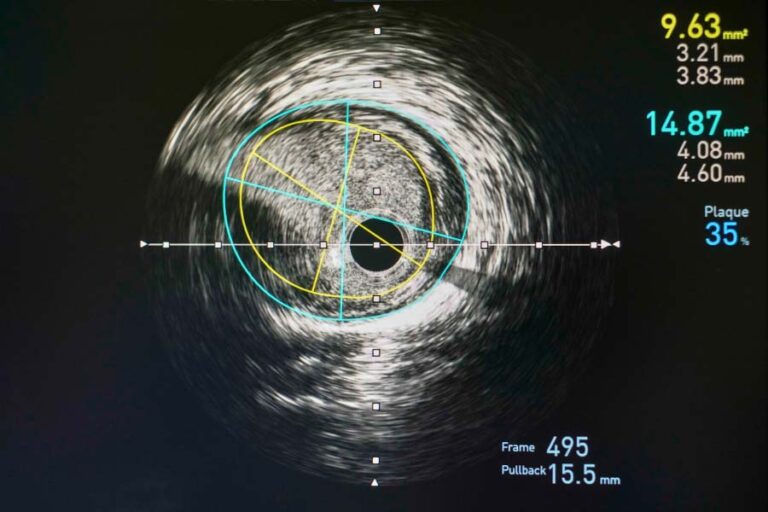 When Should I Get IVUS for Heart Disease?